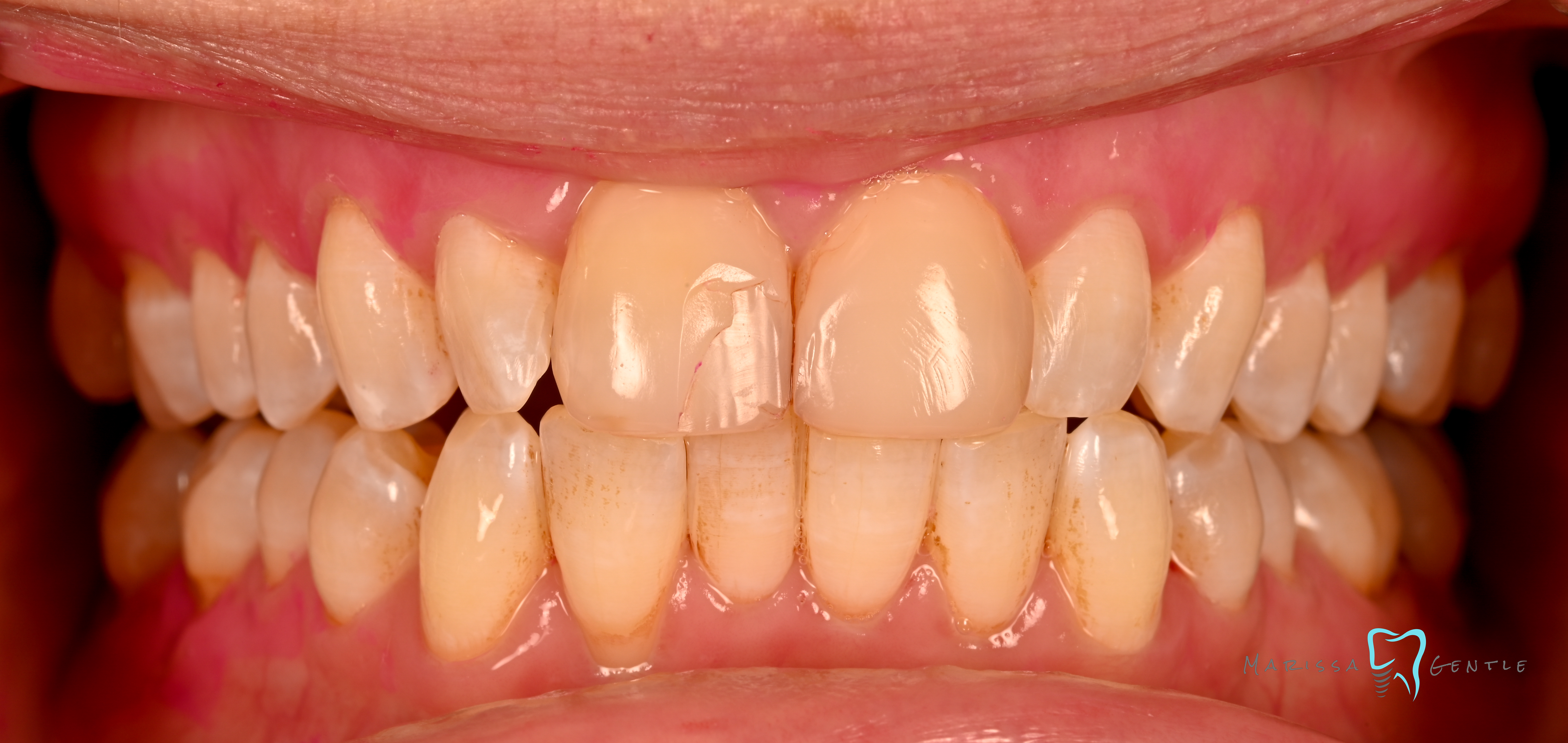 Fixed Prosthetics – Marissa Gentle DMD 2022 E-Portfolio